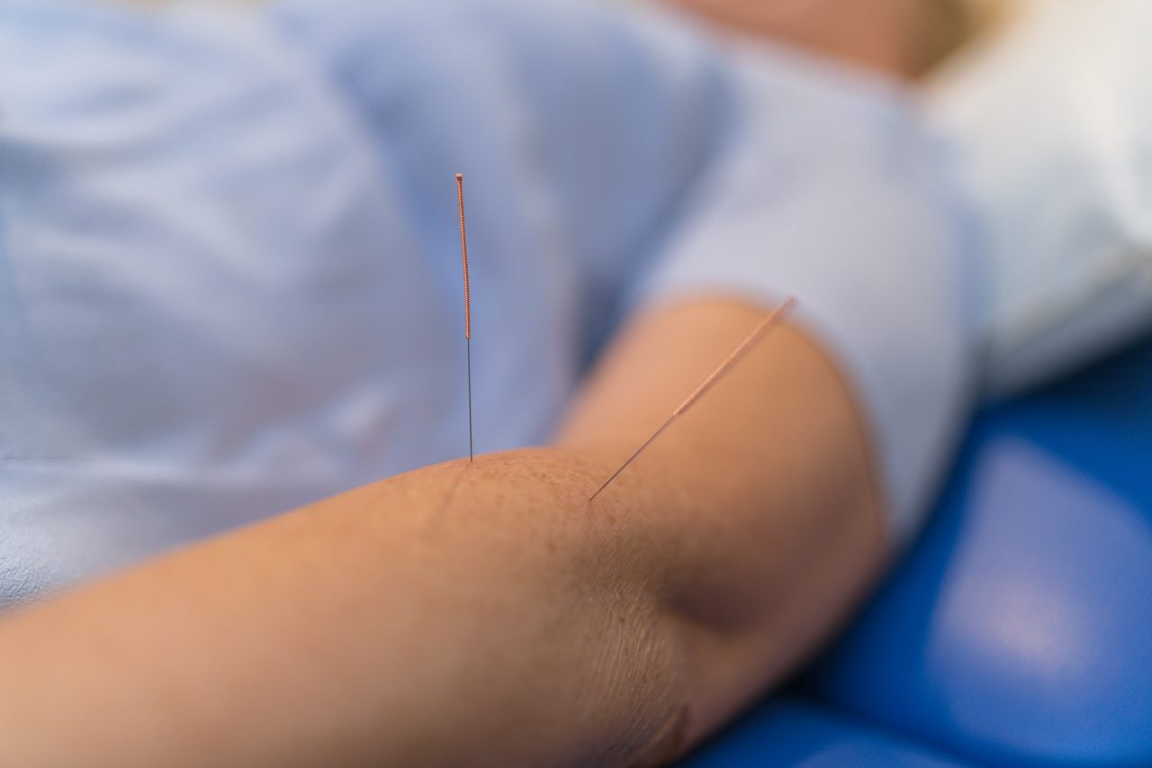 What is Acupuncture and how does it work - The Osteopathic Consultancy